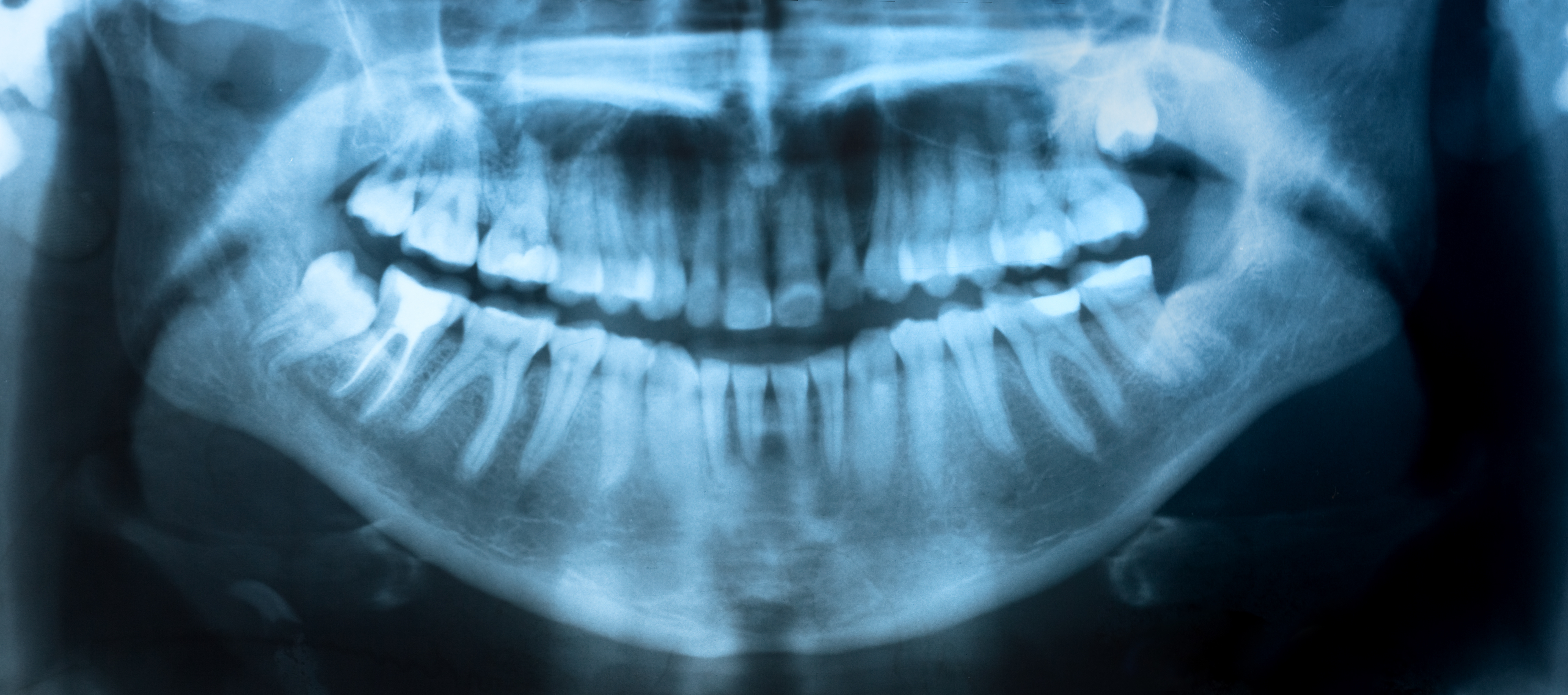 Can Short Roots Last A Long Time A Reply From The Sacramento Dentistry 